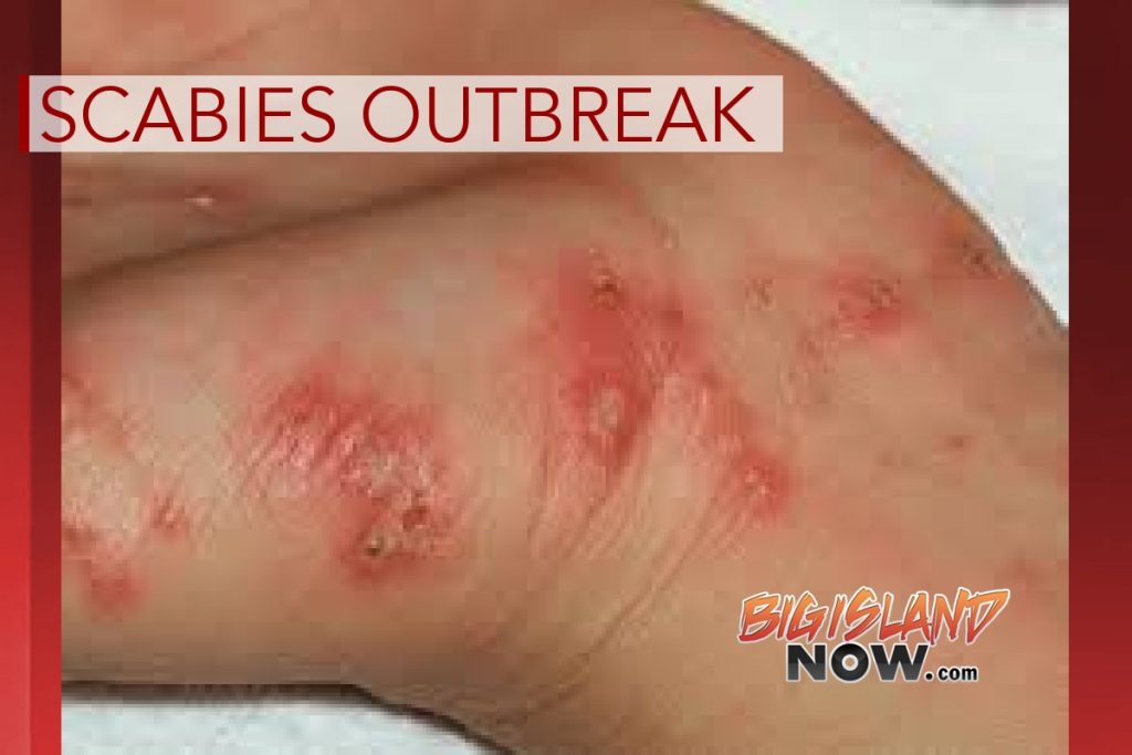 Kona Community Hospital Managing Scabies Outbreak : Big Island Now