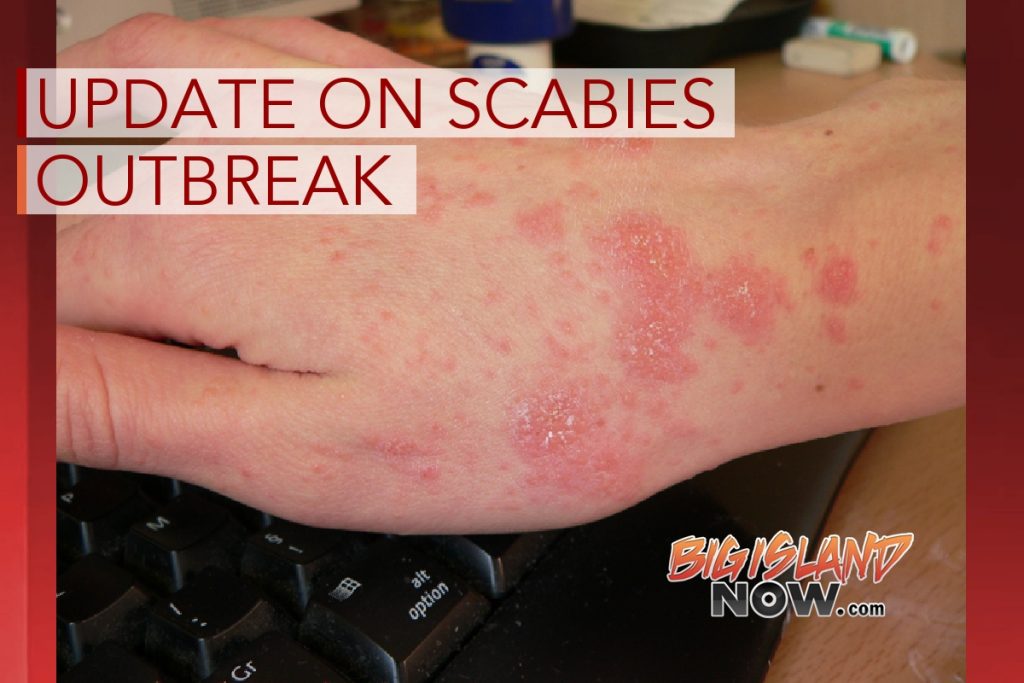 Update on Scabies Outbreak at Kona Hospital : Big Island Now